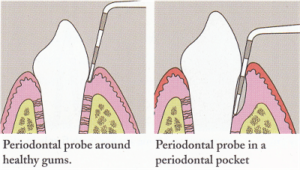Vaping & Oral Health: Bad Breath, Receding Gums, Teeth Grinding, and More