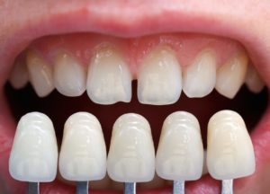 Can you whiten veneers with toothpaste or whitening strips?