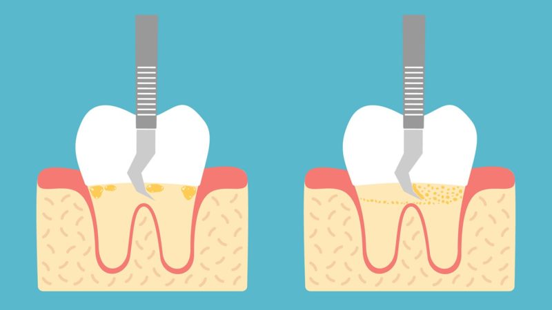 What Is a Root Planing? Dr. Mark Burhenne