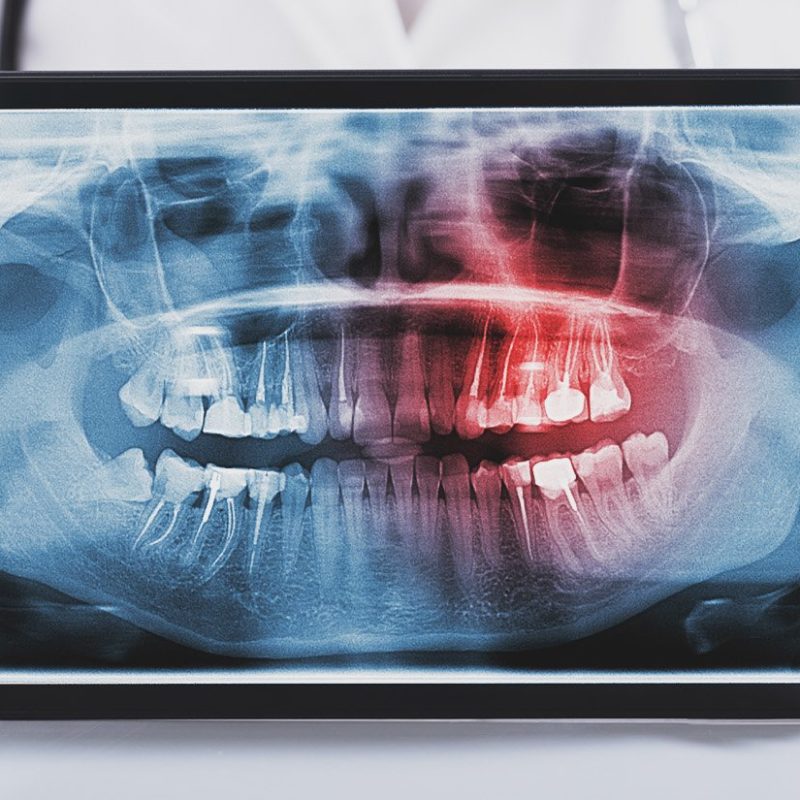 The 12 Best Ways to Whiten Teeth Fast [in 2020] - Ask the Dentist