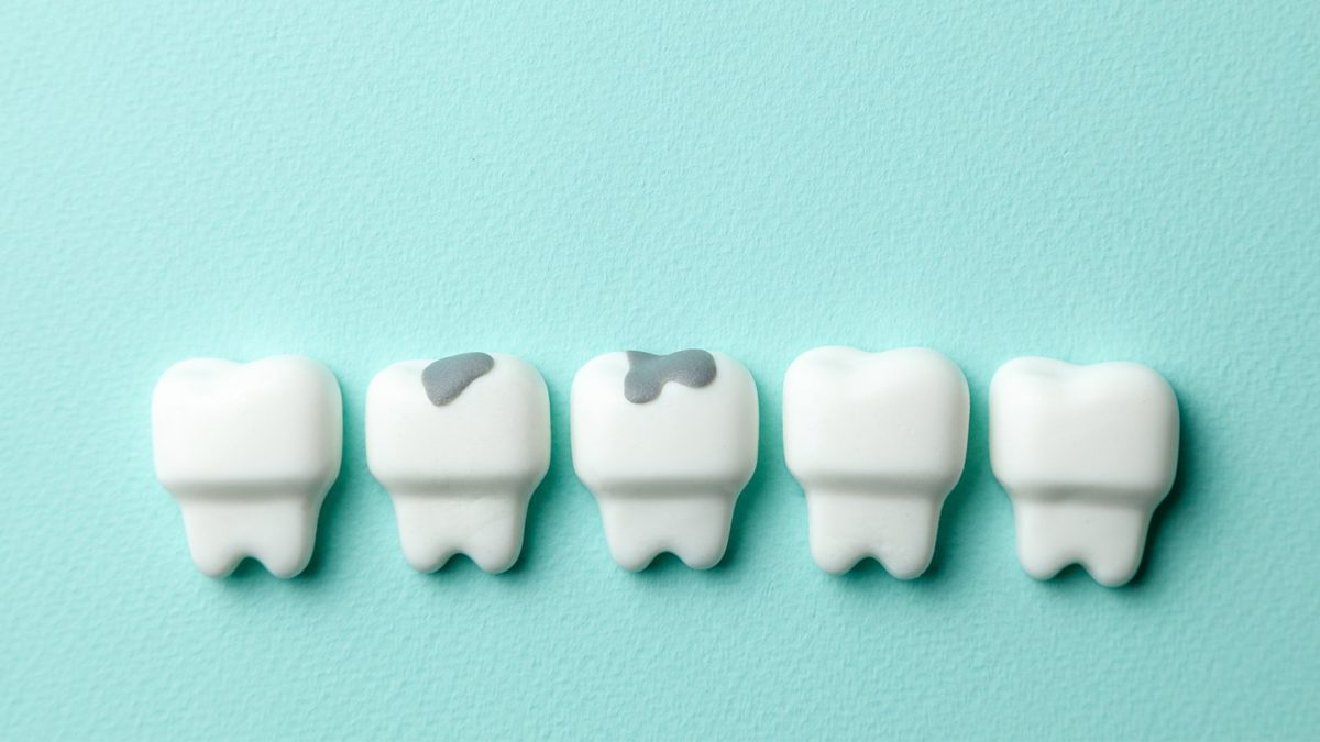 Amalgam Fillings: Are they safe? Should you have them removed?