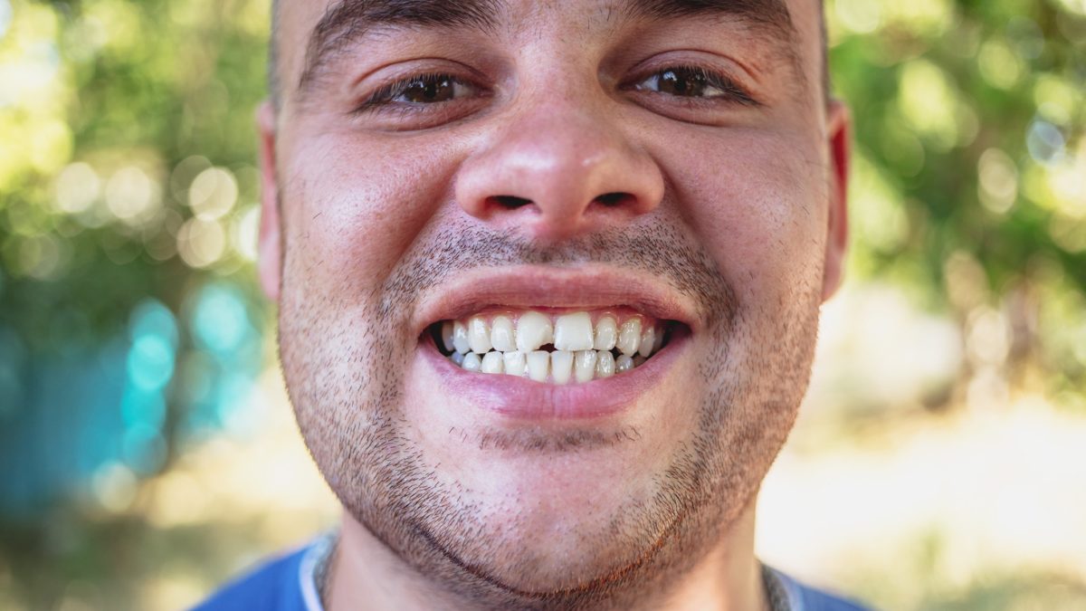 Cracked/Chipped Teeth Archives - Ask the Dentist