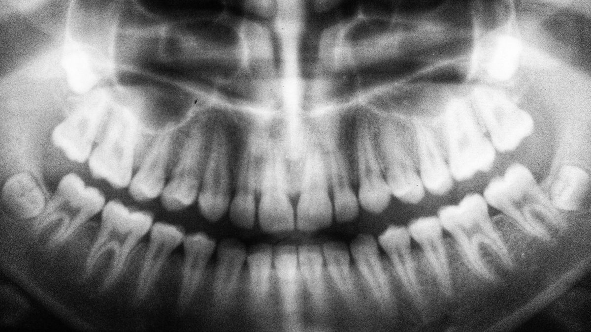 Invisible Risks of X-Rays [Are dental x-rays safe?] - Ask the Dentist