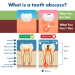 Tooth Abscess Symptoms, Remedies, Complications & Prevention